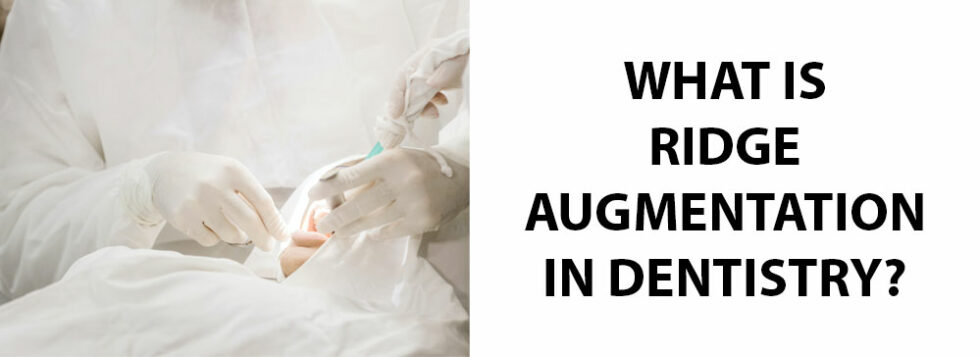 The Ridge Augmentation in Dentistry Guide: What Is It