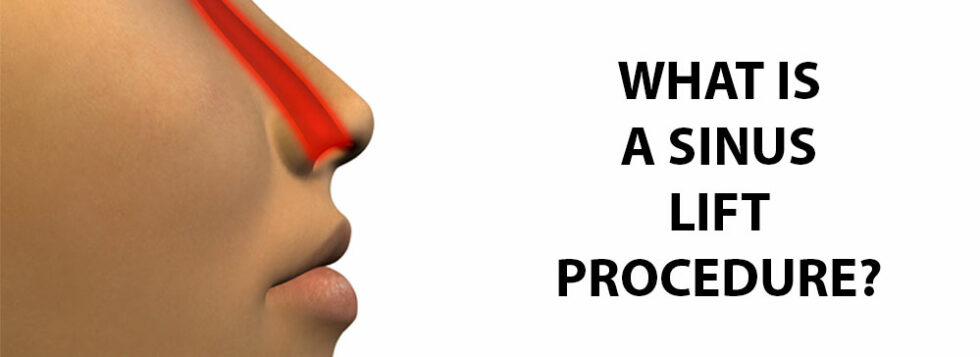 The Sinus Lift Procedure Guide: What You Can Expect