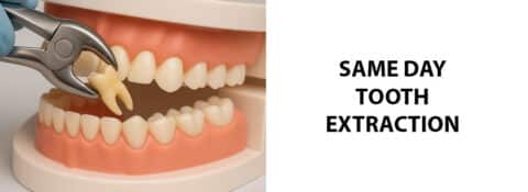 The Same Day Tooth Extraction & Implant Guide