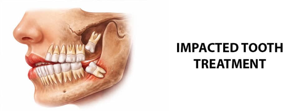 What Is An Impacted Tooth? The Symptoms & Causes